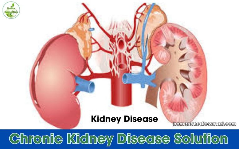 The Chronic Kidney Disease Solution Review - Home Remedies Smart
